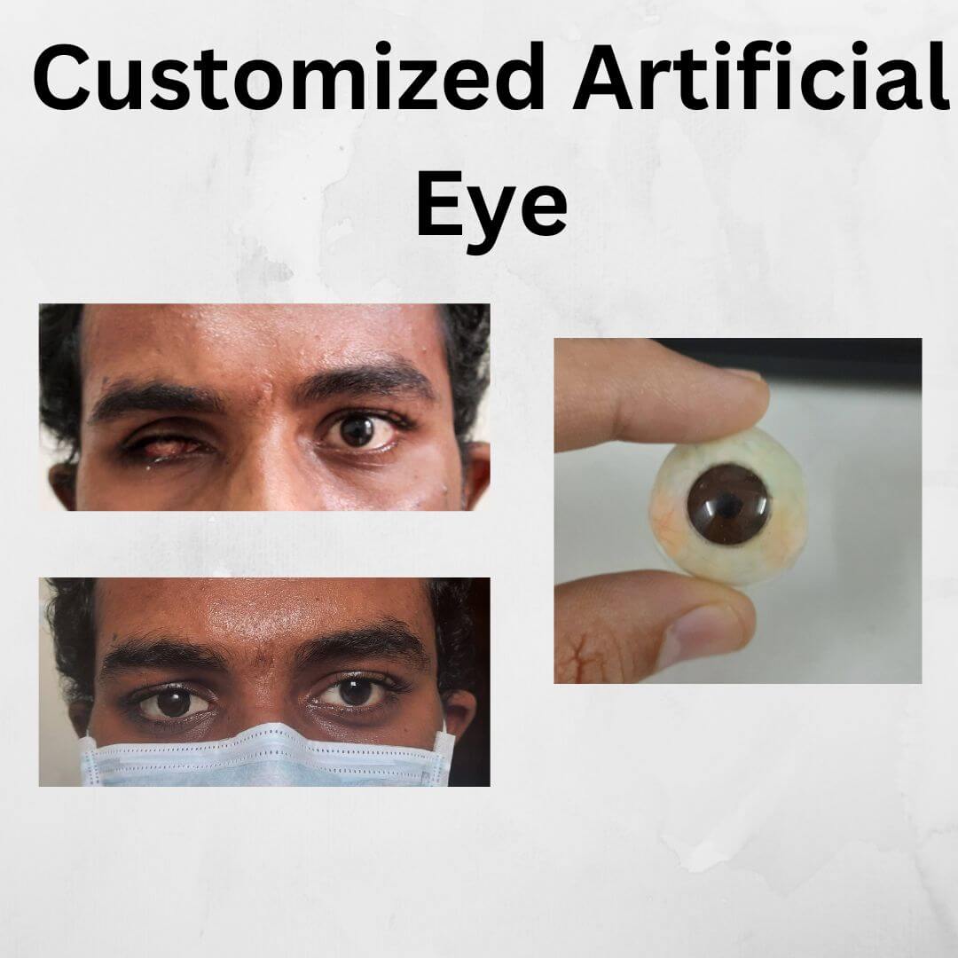 Artificial eye clinic in Hyderabad - Reform Vision