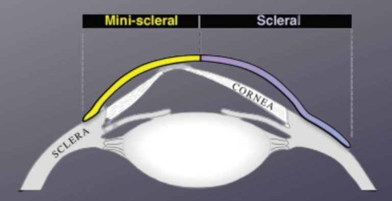 Scleral Lenses in Hyderabad - Reform Vision